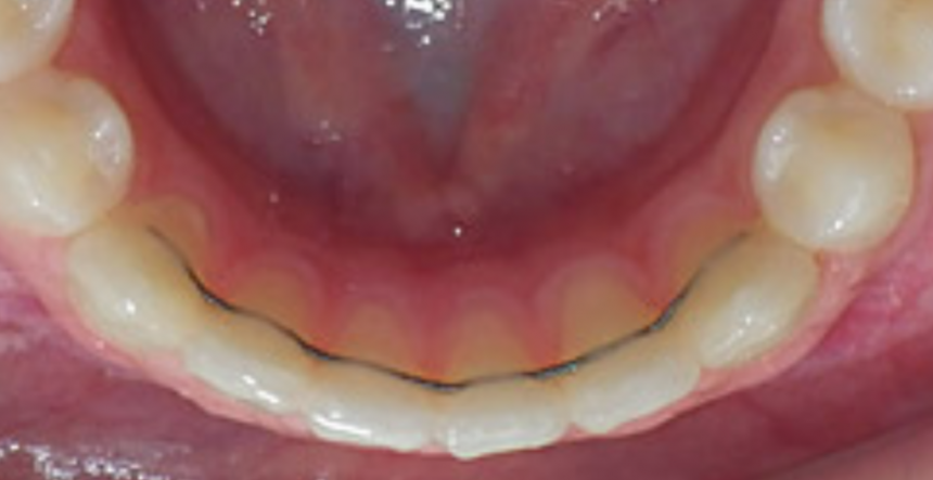 Pendant le traitement - Orthodontiste